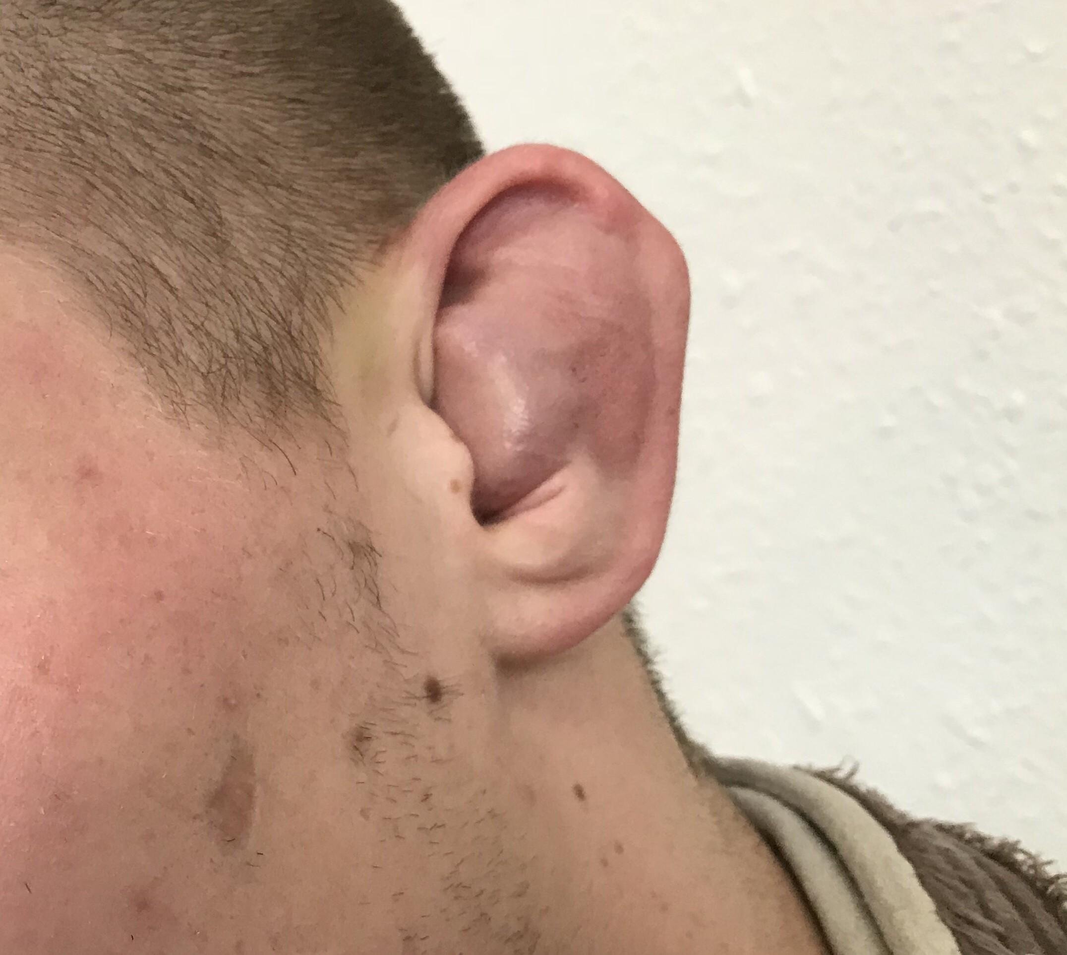 how to make cauliflower ear harden faster