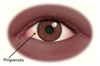 An eye condition that I didn’t even know existed: Let me introduce you ...