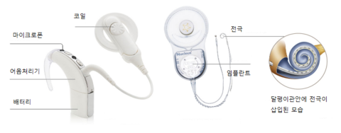 인공와우란(cochlear implant) — Steemit