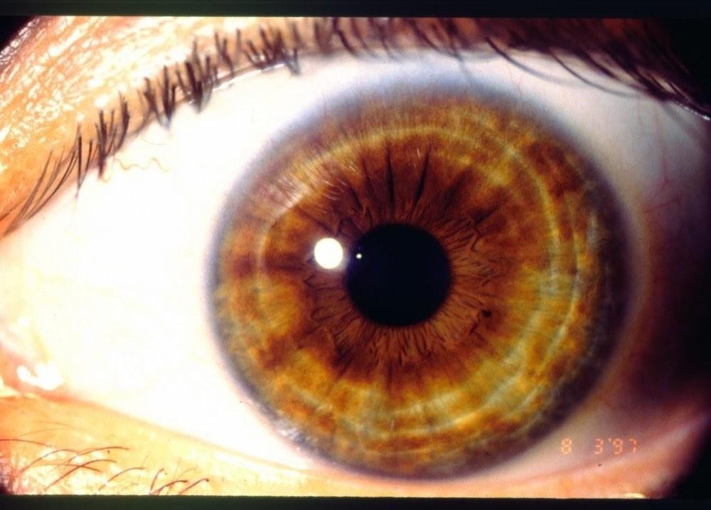 Nerve Rings in Iridology 👁️