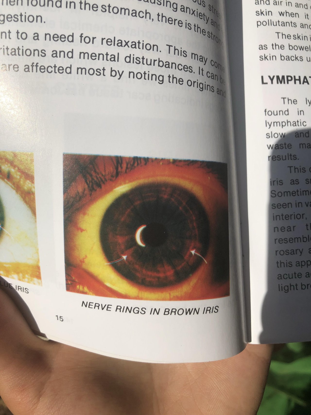 Nerve Rings in Iridology 👁️