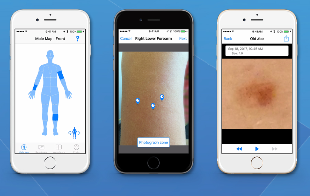 Mole Mapper - Skin Cancer Tracking App| Map, Measure & Monitor | Steemhunt