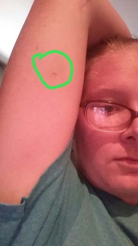 My Experience With Nexplanon Birth Control