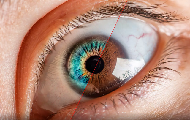 Keratopigmentation: A Comprehensive Guide to Eye Color Change Procedure ...