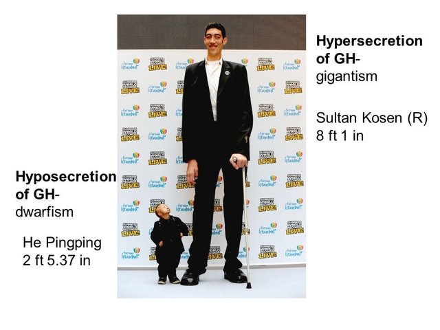 Dwarfism Pituitary Causes Symptoms Treatment Dwarfism