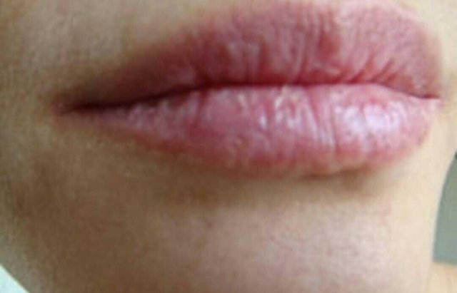 Herpes Simplex Lips Itchy | Lipstutorial.org