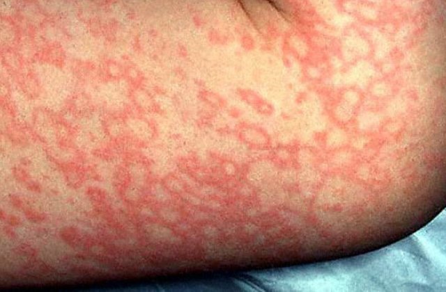 Fifth Disease In Adults