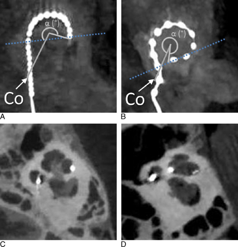 인공와우란(cochlear implant) — Steemit