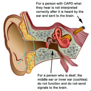 Learning Disabilities: Auditory Processing Disorder — Steemit