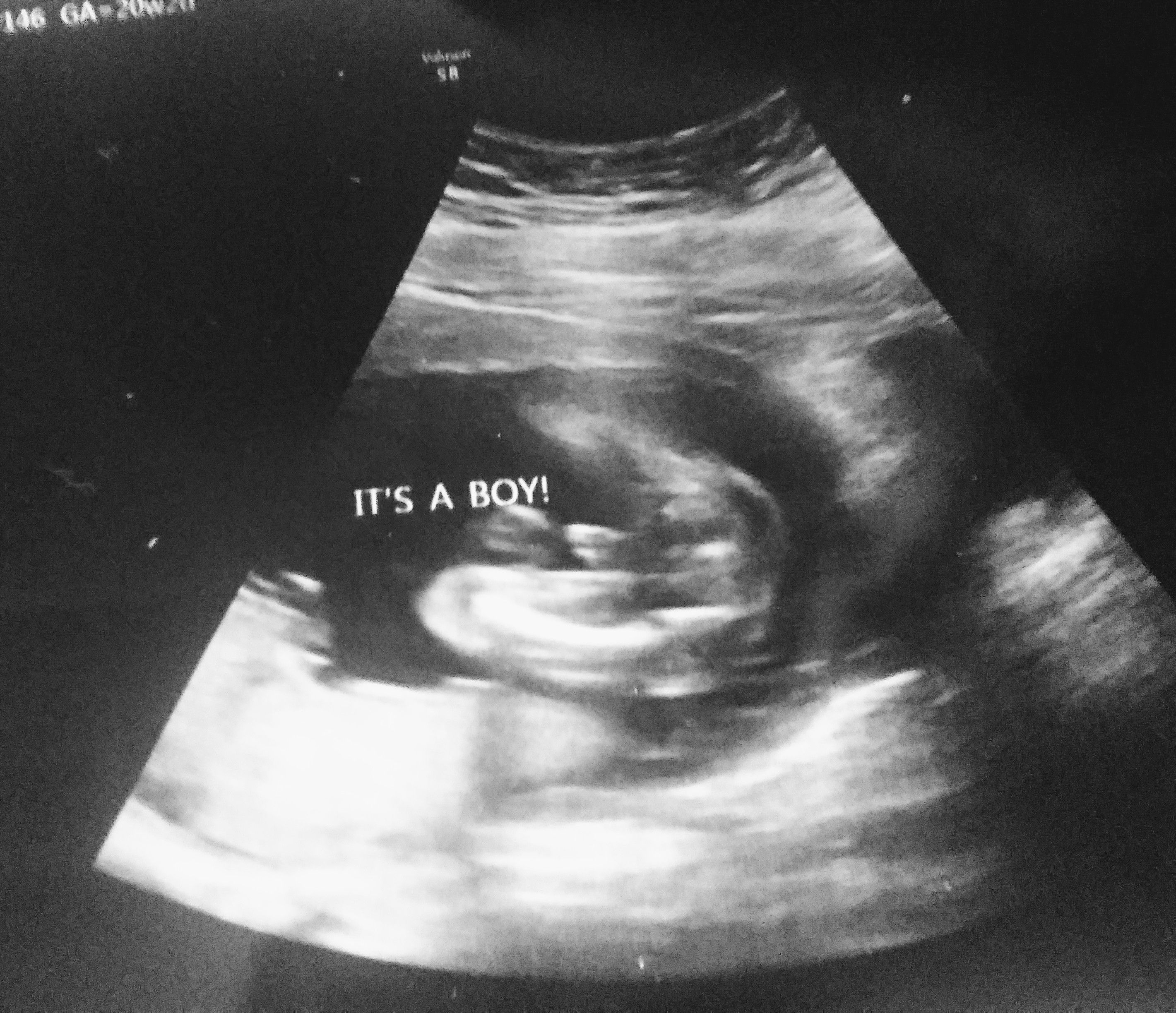 Its A Boy Ultrasound 20 Weeks Its A Boy Ultrasound 20 Weeks